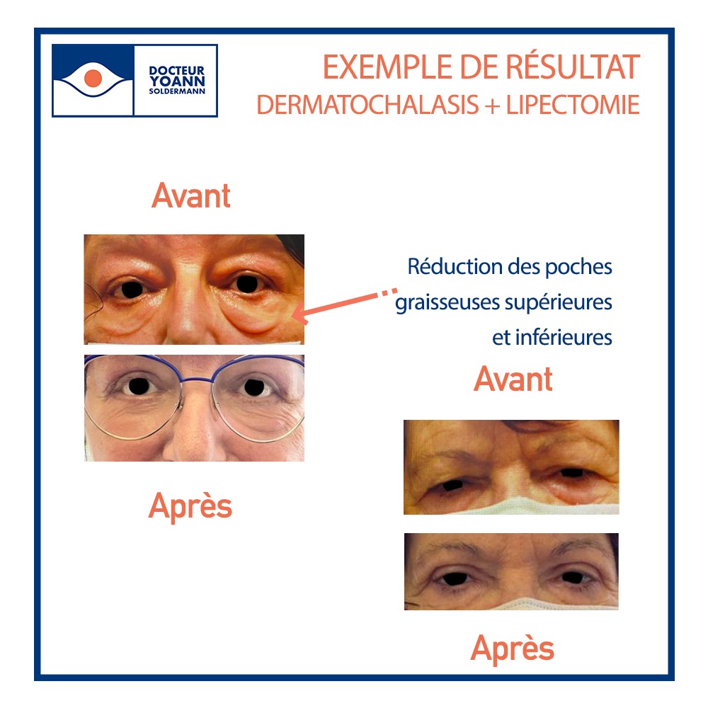 Vos questions sur le dermatochalasis : - Chirurgie Paupière