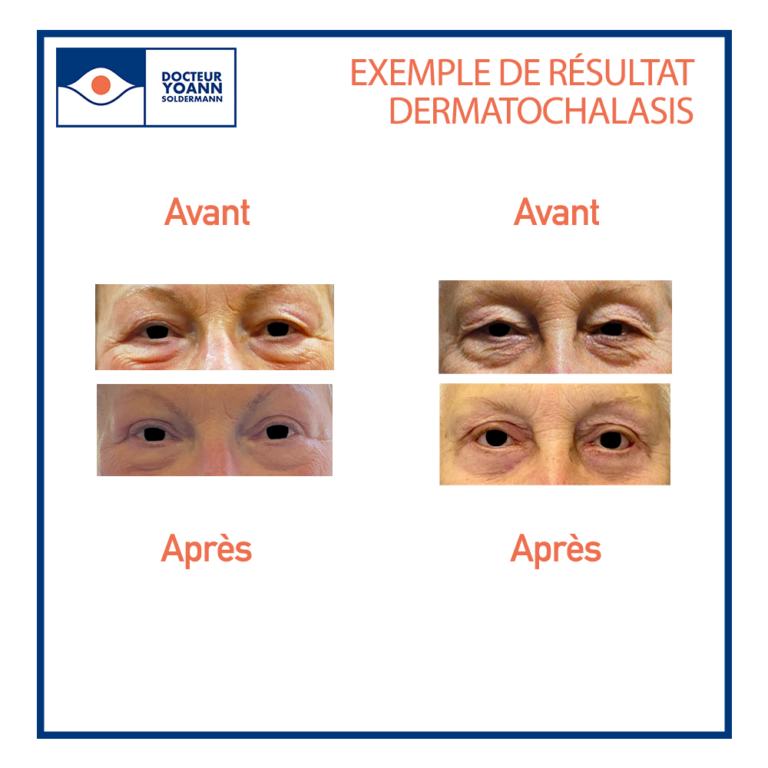Vos questions sur le dermatochalasis : - Chirurgie Paupière