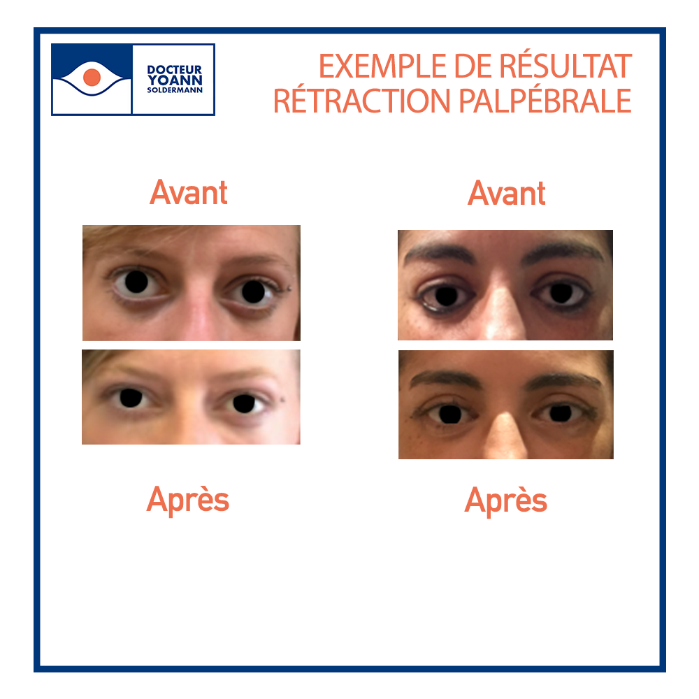Prise En Charge De La R traction Palp brale Chirurgie Paupi re Prise En Charge De La R traction Palp brale Chirurgie Paupi re