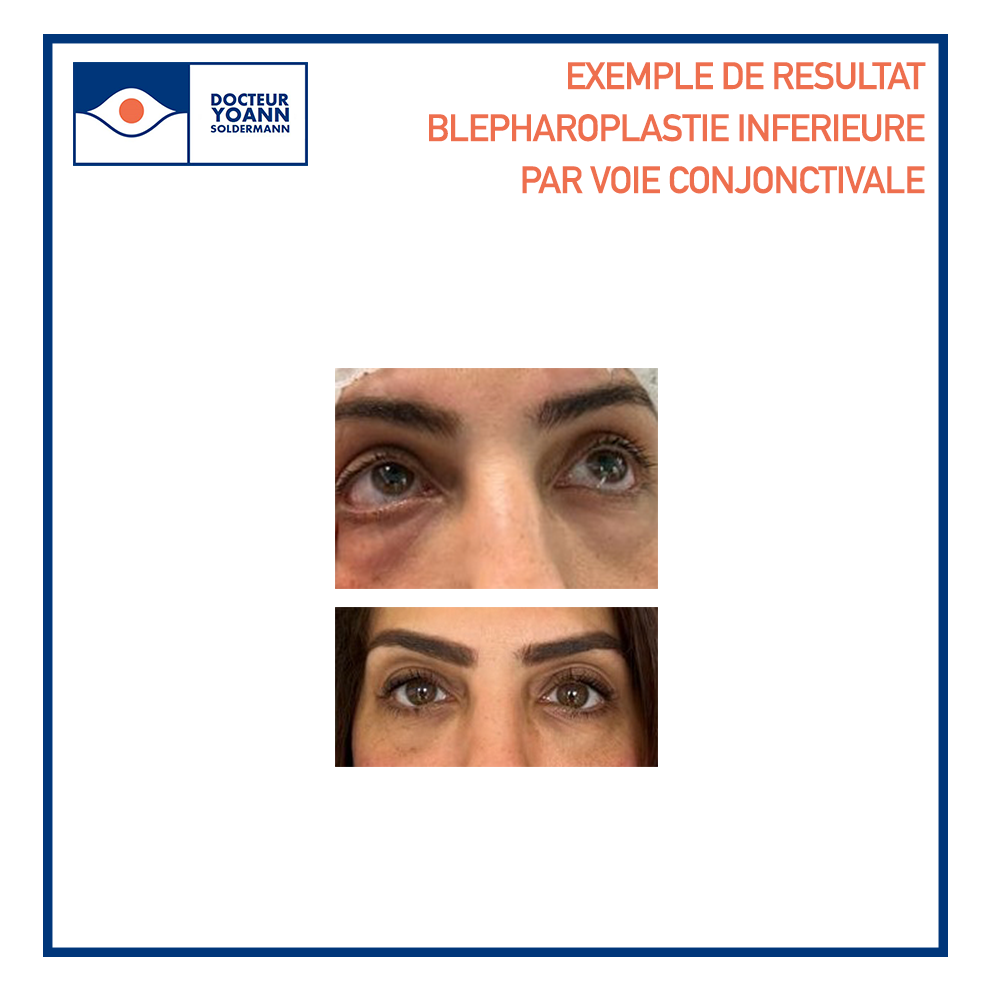 BLEPHAROPLASTIES À LYON - Chirurgie Paupière