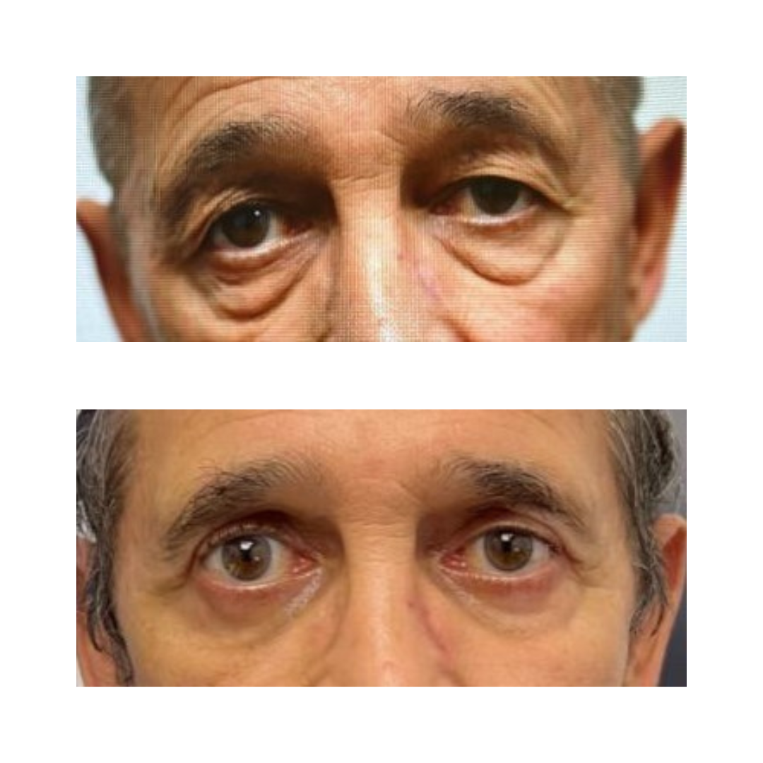 Blépharoplastie : les 4 paupières sont-elles opérables en même temps