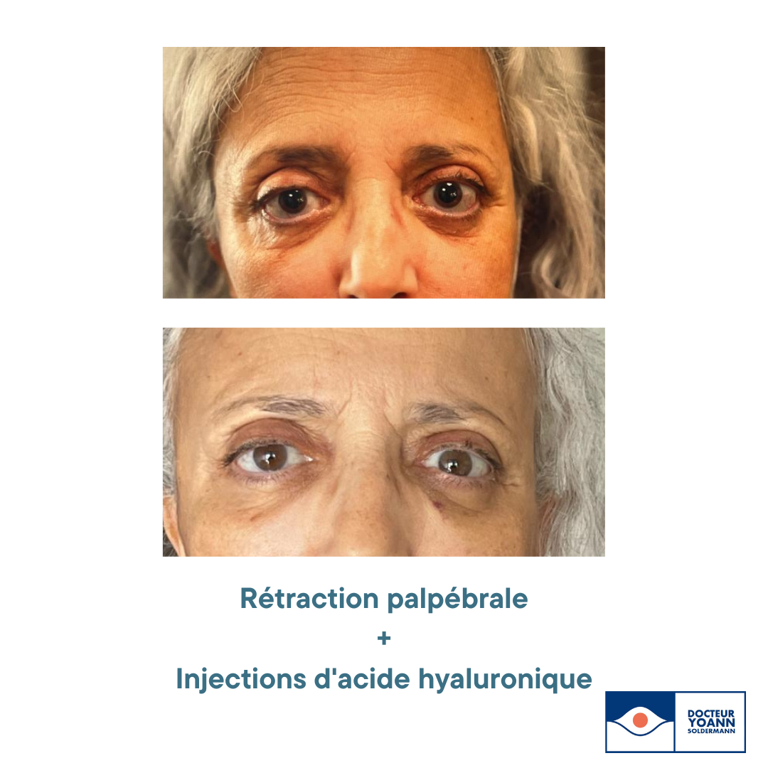 La rétraction palpébrale : une solution chirurgicale - Chirurgie Paupière