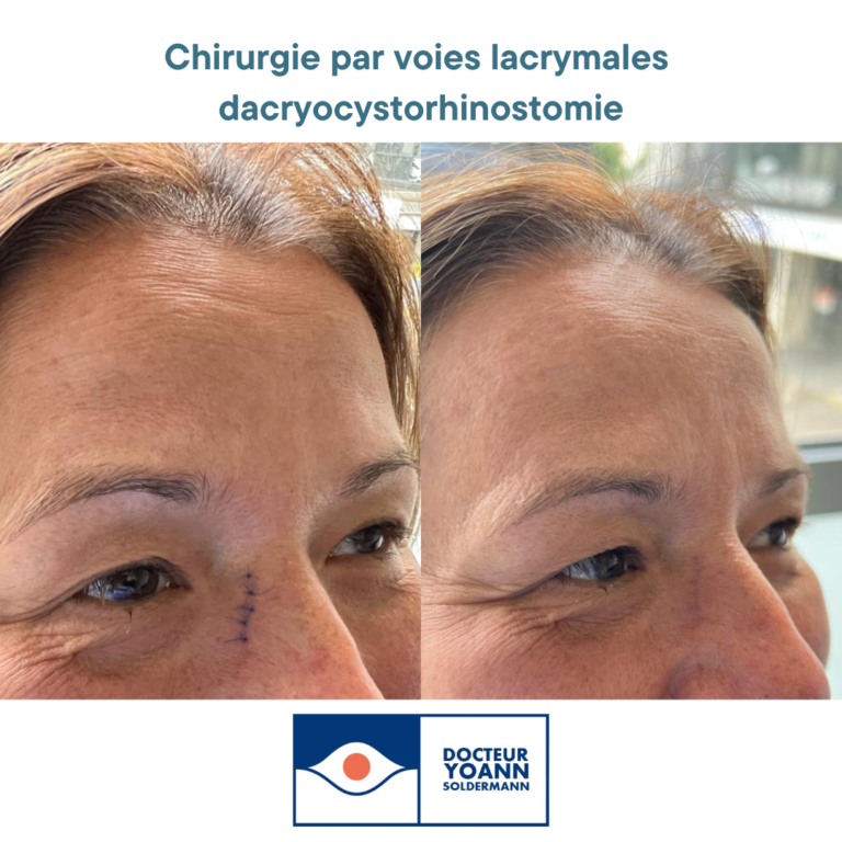 La chirurgie par voies lacrymales : la dacryocystorhinostomie ...