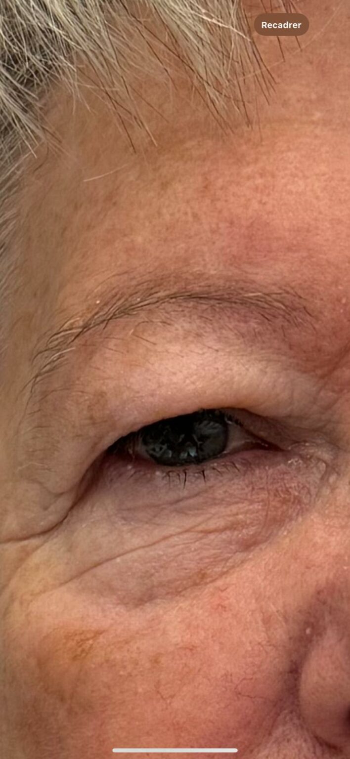 Le Blépharochalasis - Chirurgie Paupière